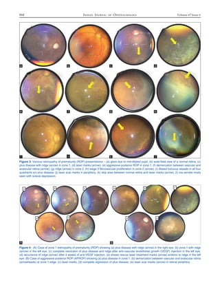 Smartphone guided wide-field imaging for retinopathy of prematurity in ...