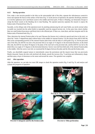 One Case of Internal Fixation Treatment for Tibia and Fibula Fracture ...