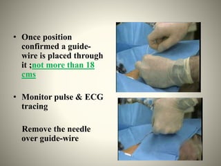 anatomical review of internal jugular vein cannulation.pptx