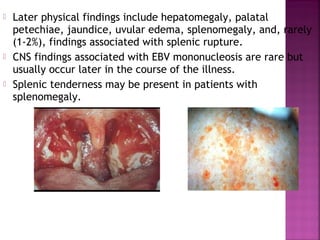 Infectious mononucleosis | PPT