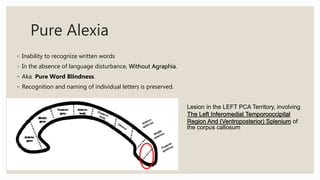 Disconnection_syndrome.pptx | Brain and Nervous System Disorders ...