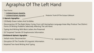 Disconnection_syndrome.pptx | Brain and Nervous System Disorders | Diseases and Conditions