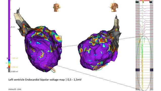 Endocardial and Epicardial Ventricular Tachycardia substrate 3D mapping ...