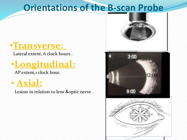 Ultrasonic Evaluation of Eyes With Blunt Trauma