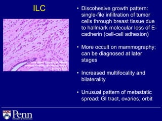 Invasive Lobular Carcinoma: Biology, Treatment, and Future Directions ...