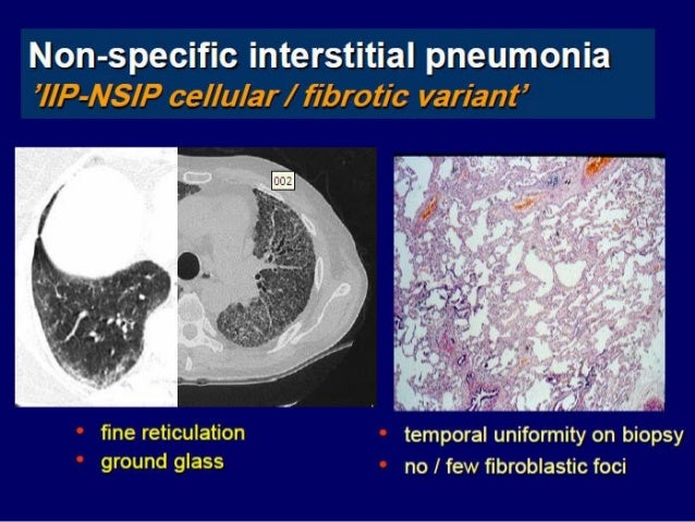 Interstitial Lung Diseases