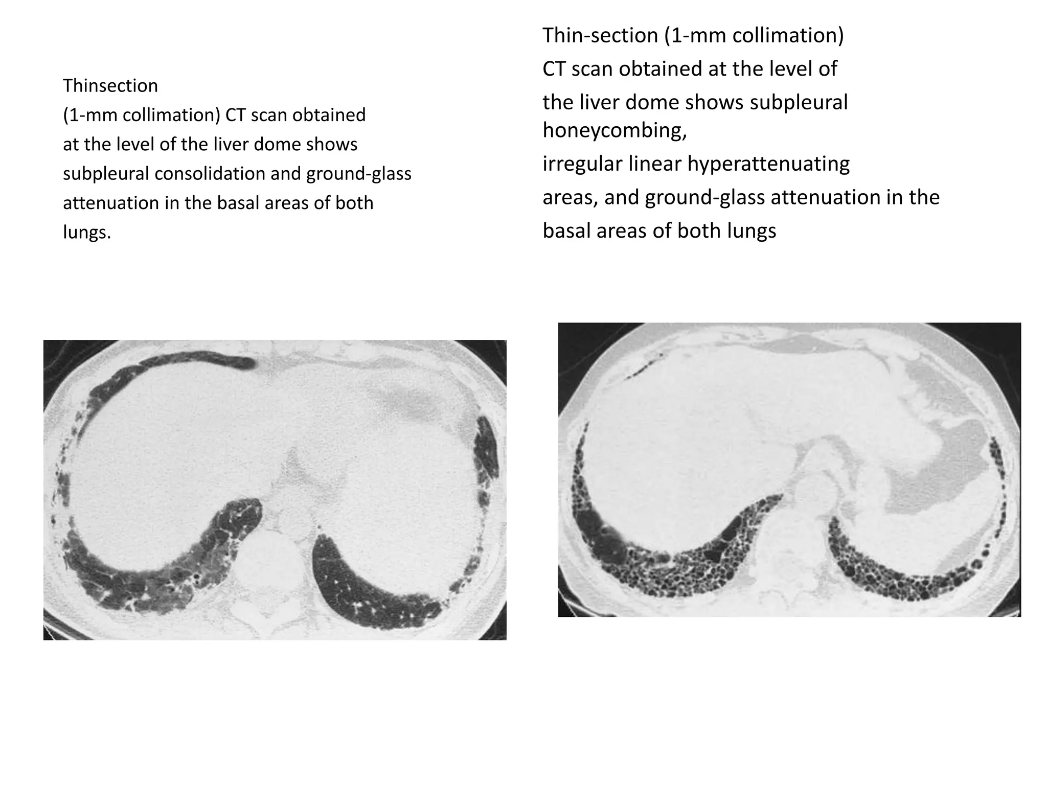 Connective tissue disease associated ILD | PPTX
