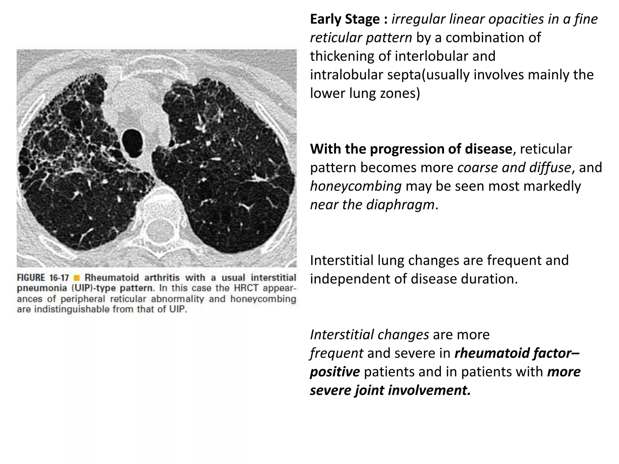 Connective tissue disease associated ILD | PPTX