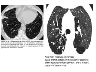 Connective tissue disease associated ILD | PPTX