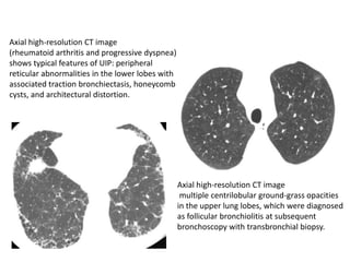 Connective tissue disease associated ILD | PPTX