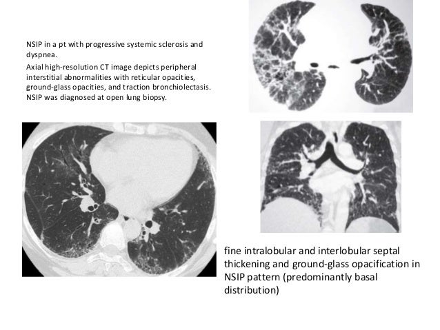 Connective tissue disease associated ILD