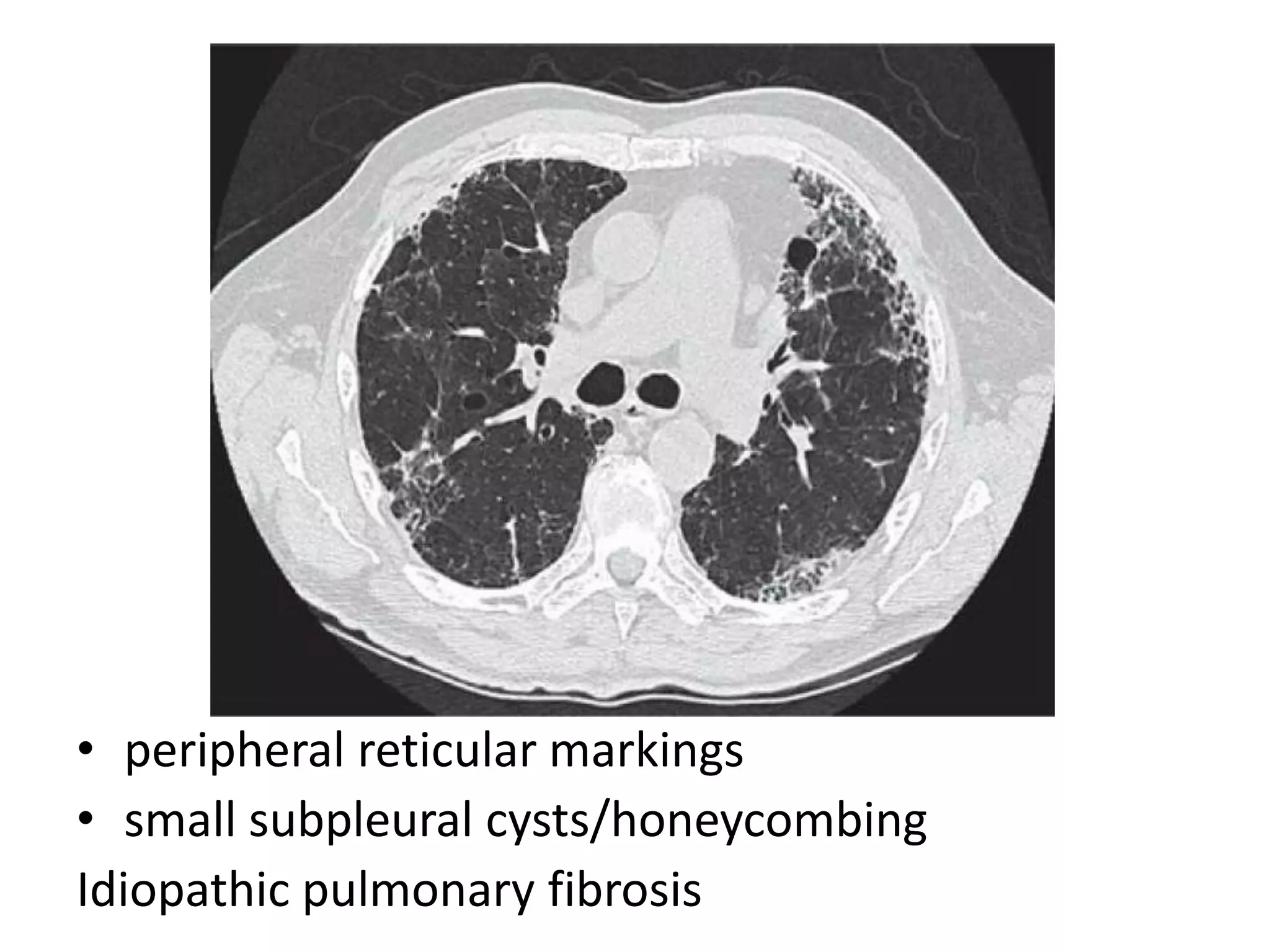 Interstitial Lung Disease | PPTX