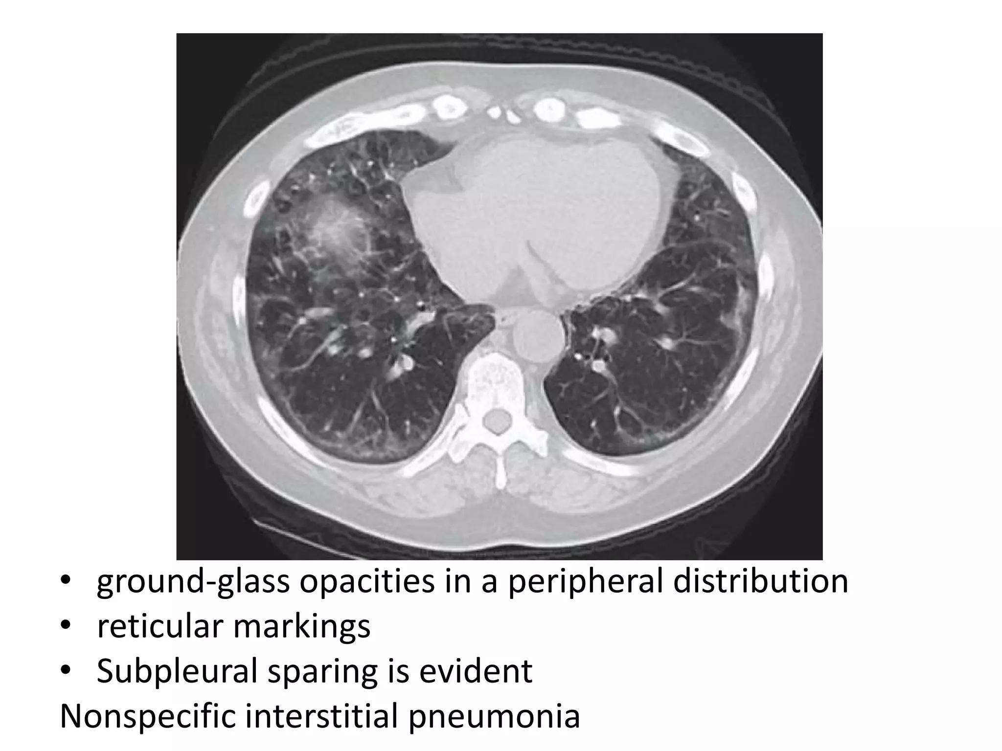 Interstitial Lung Disease | PPTX