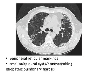 Interstitial Lung Disease Honeycombing