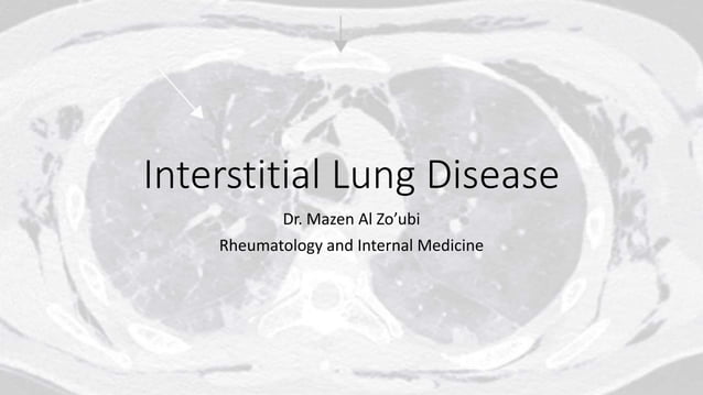 Interstitial Lung Disease | PPTX | Lung and Respiratory Health | Diseases and Conditions