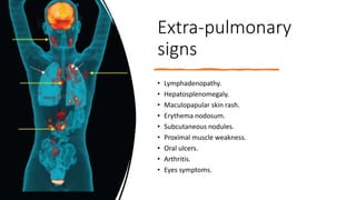 Interstitial Lung Disease | PPTX