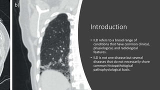 Interstitial Lung Disease | PPTX