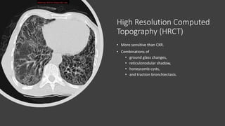 Interstitial Lung Disease | PPTX