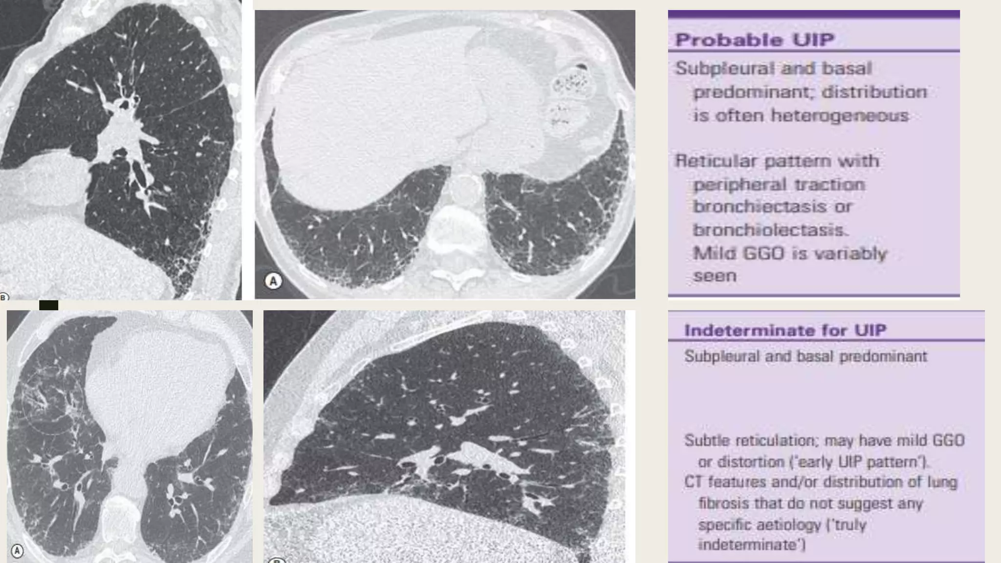 Interstitial lung disease and Occupational lung disease HRCT | PPTX