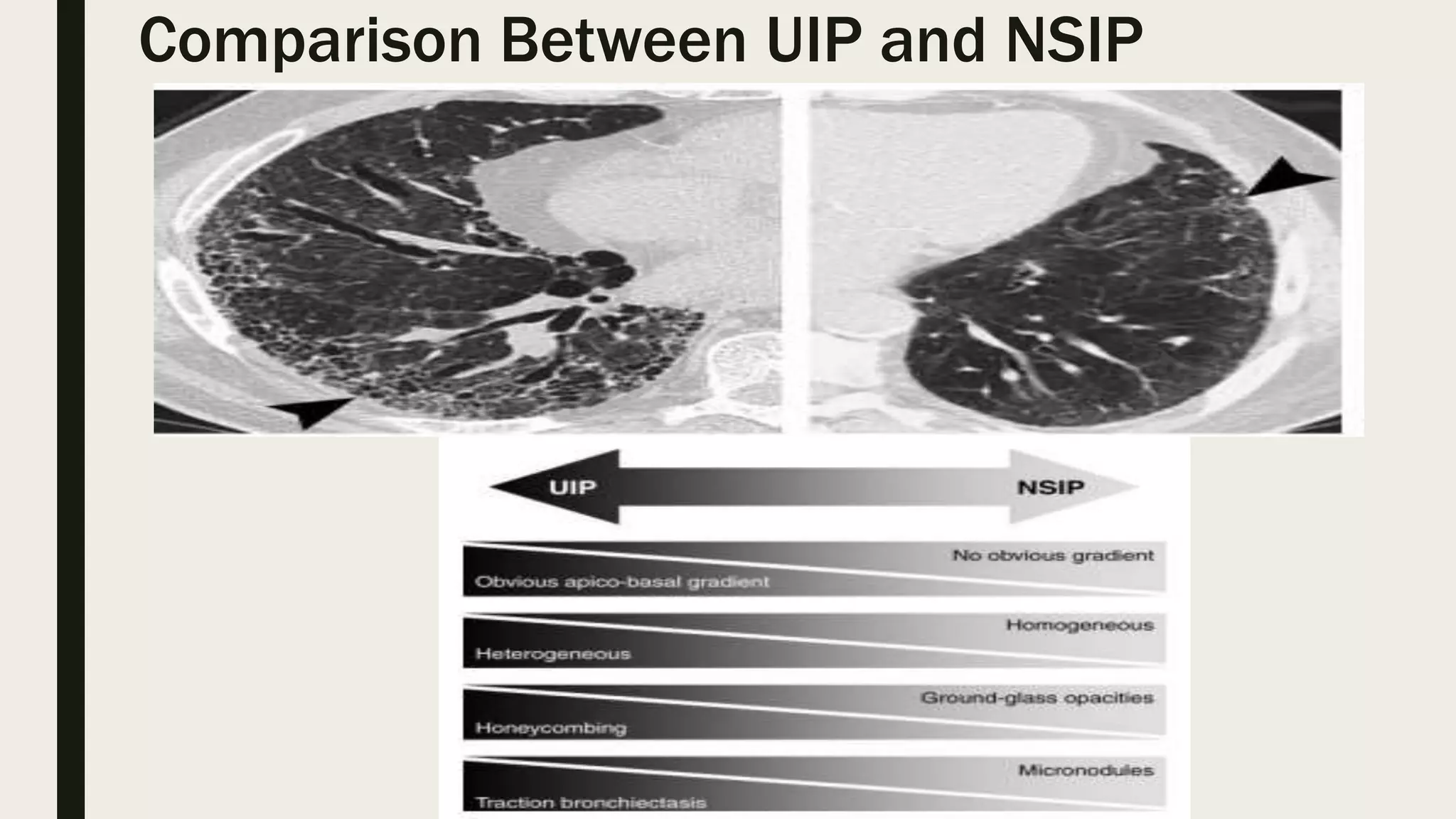 Interstitial lung disease and Occupational lung disease HRCT | PPTX
