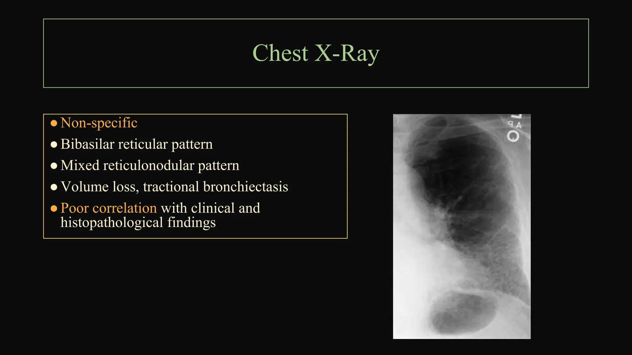 INTERSTITIAL LUNG DISEASE Pattern Approach main.pptx