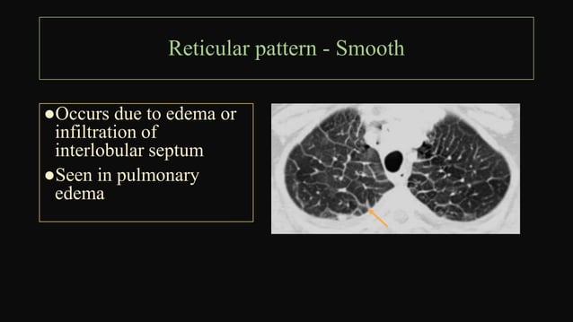INTERSTITIAL LUNG DISEASE Pattern Approach main.pptx