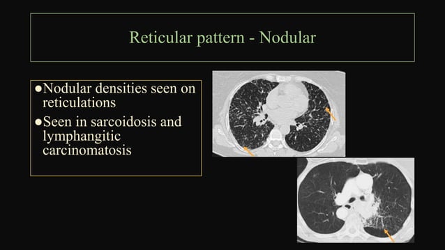 INTERSTITIAL LUNG DISEASE Pattern Approach main.pptx