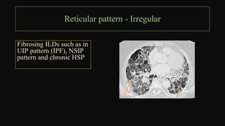 INTERSTITIAL LUNG DISEASE Pattern Approach main.pptx
