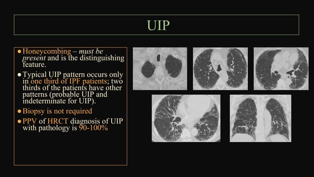 INTERSTITIAL LUNG DISEASE Pattern Approach main.pptx