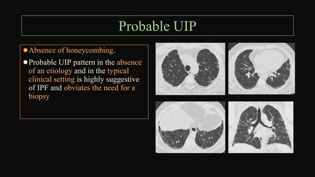 INTERSTITIAL LUNG DISEASE Pattern Approach main.pptx