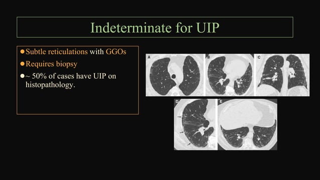 INTERSTITIAL LUNG DISEASE Pattern Approach main.pptx
