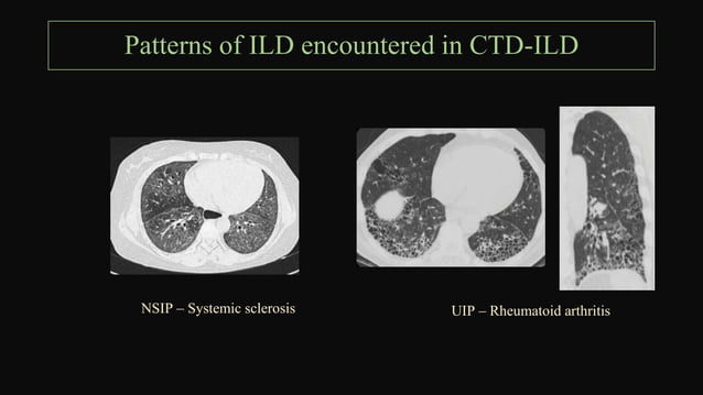 INTERSTITIAL LUNG DISEASE Pattern Approach main.pptx