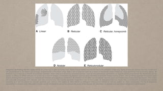 Interstitial Lung Disease (ILD) pptx .pptx