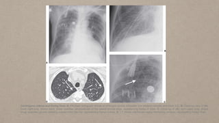Interstitial Lung Disease (ILD) pptx .pptx