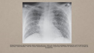 Interstitial Lung Disease (ILD) pptx .pptx