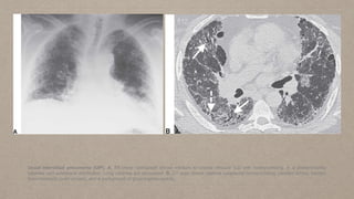 Interstitial Lung Disease (ILD) pptx .pptx