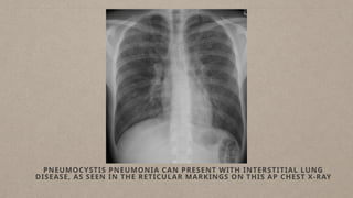Interstitial Lung Disease (ILD) pptx .pptx