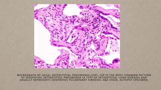 Interstitial Lung Disease (ILD) pptx .pptx