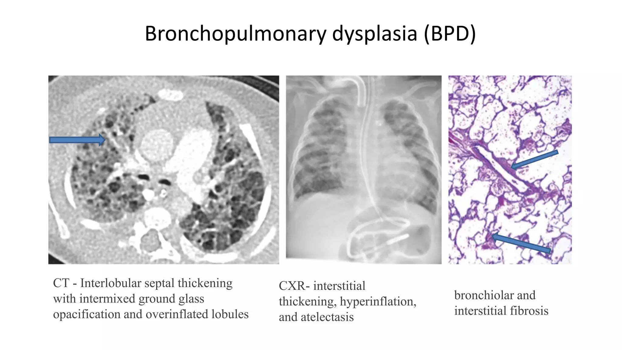 Childhood Interstitial lung disease (ILD) | PPTX