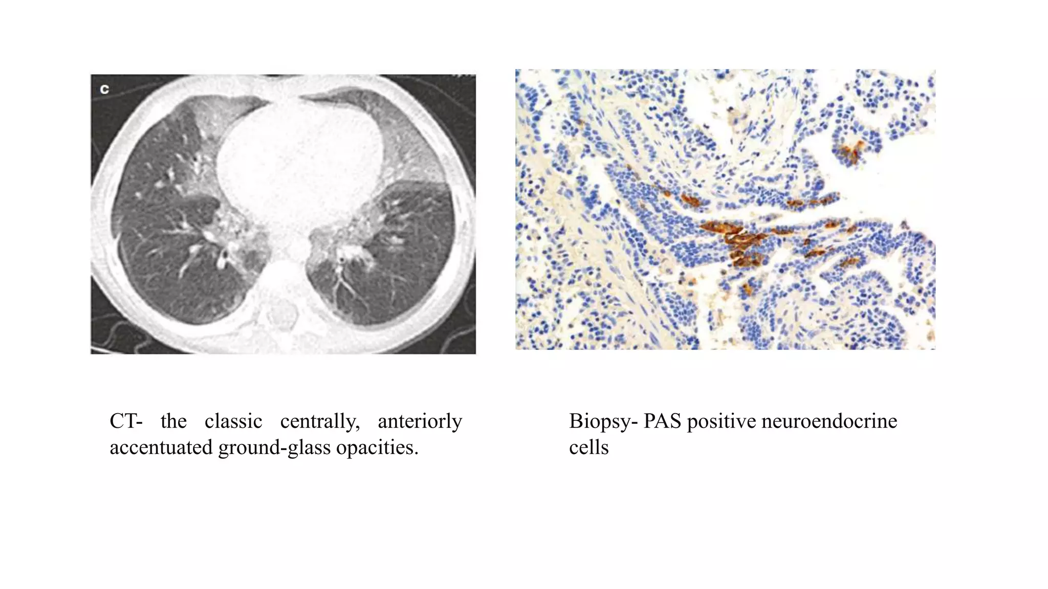 Childhood Interstitial lung disease (ILD) | PPTX