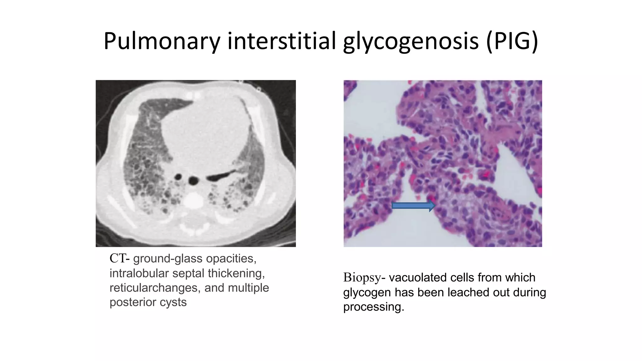 Childhood Interstitial lung disease (ILD) | PPTX