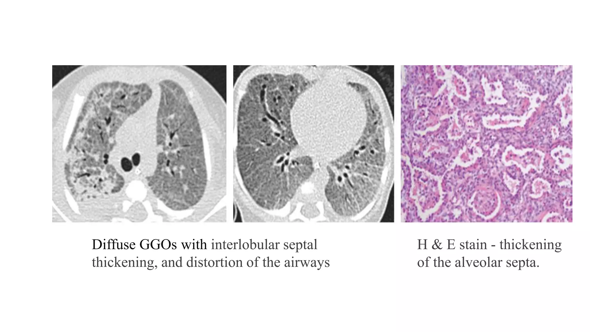 Childhood Interstitial lung disease (ILD) | PPTX