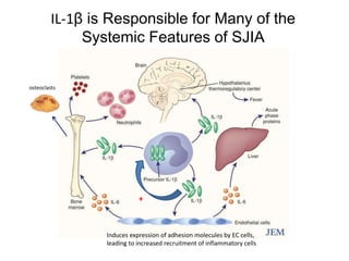 Immune Mechanisms of Inflamation in SJIA | PPTX