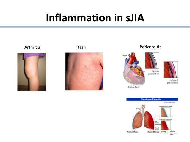 Immune Mechanisms of Inflamation in SJIA