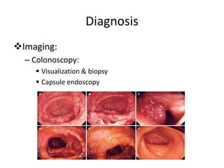Ileocaecal tb | PPTX