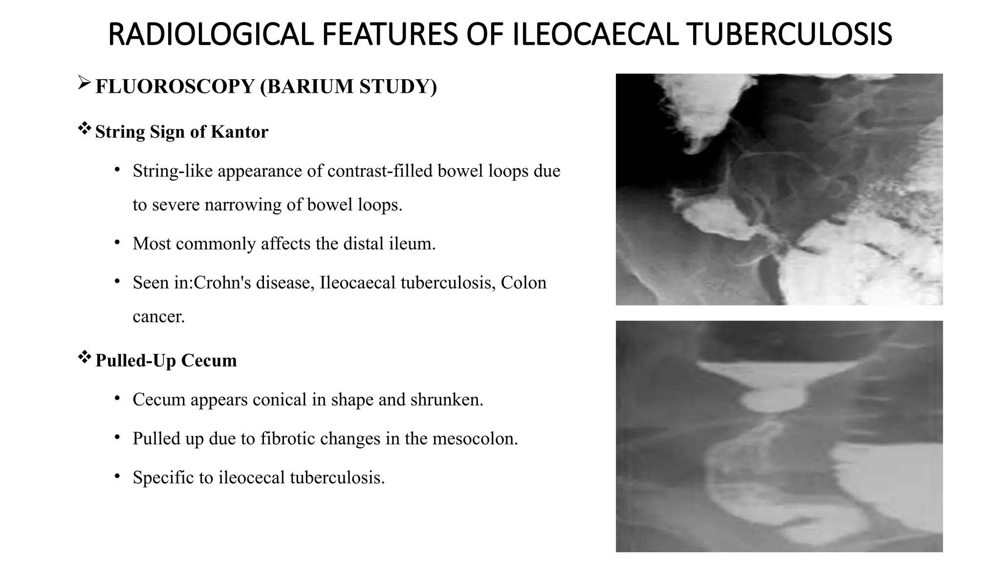 ILEOCECAL TB VS CROHNS DISEASE.pptxhhshhs | PPTX