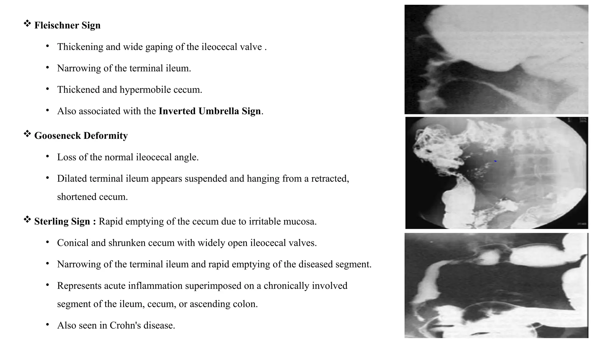 ILEOCECAL TB VS CROHNS DISEASE.pptxhhshhs | PPTX