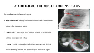 ILEOCECAL TB VS CROHNS DISEASE.pptxhhshhs | PPTX