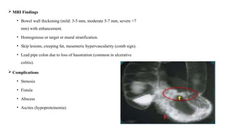 ILEOCECAL TB VS CROHNS DISEASE.pptxhhshhs | PPTX