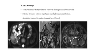 ILEOCECAL TB VS CROHNS DISEASE.pptxhhshhs | PPTX